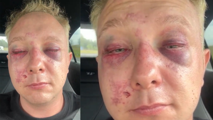 Tragiczny stan Daniela Magicala po walce... [VIDEO]